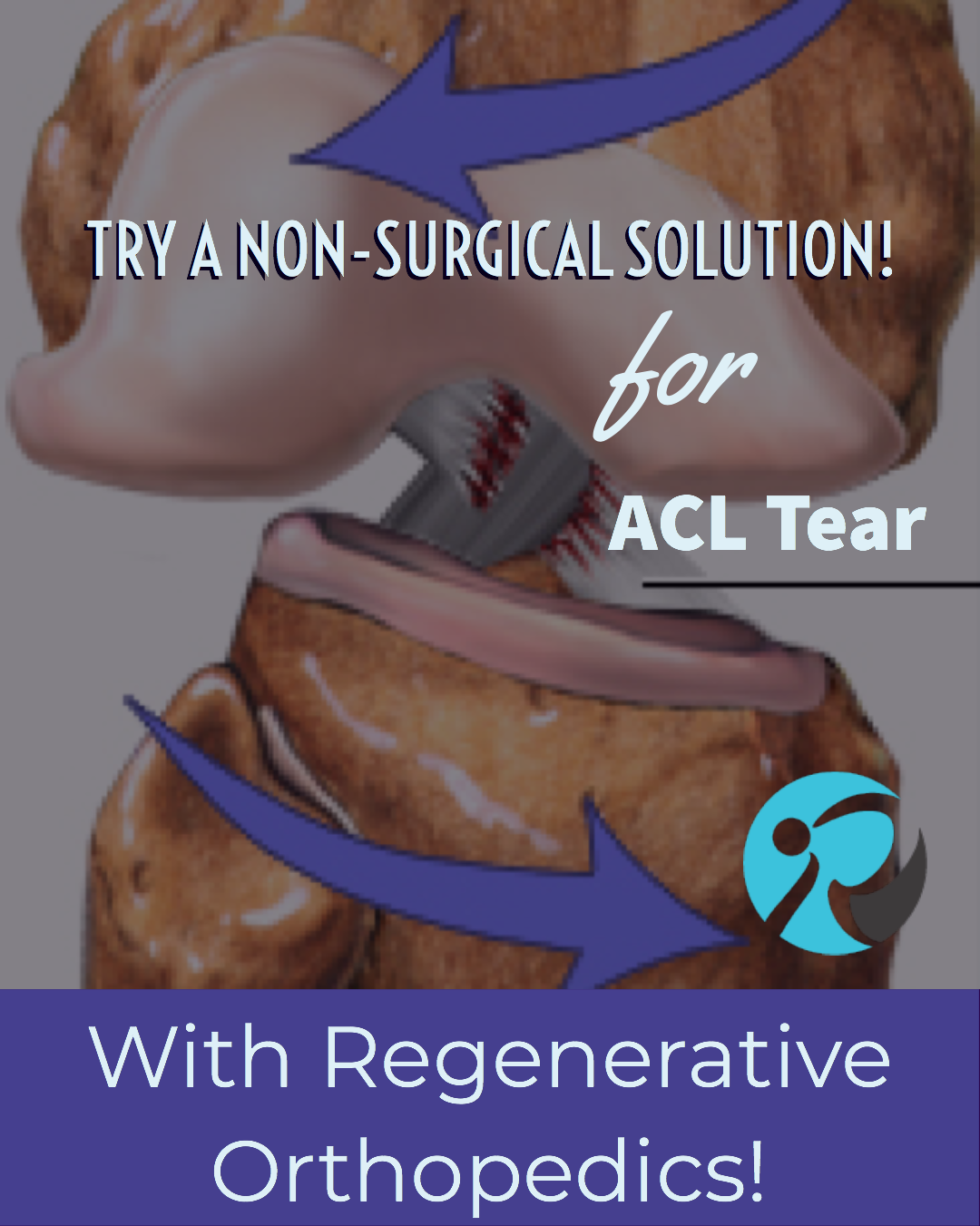 ACL Tears and Knee Ligament Injuries - Peter A. Fields, MD, DC