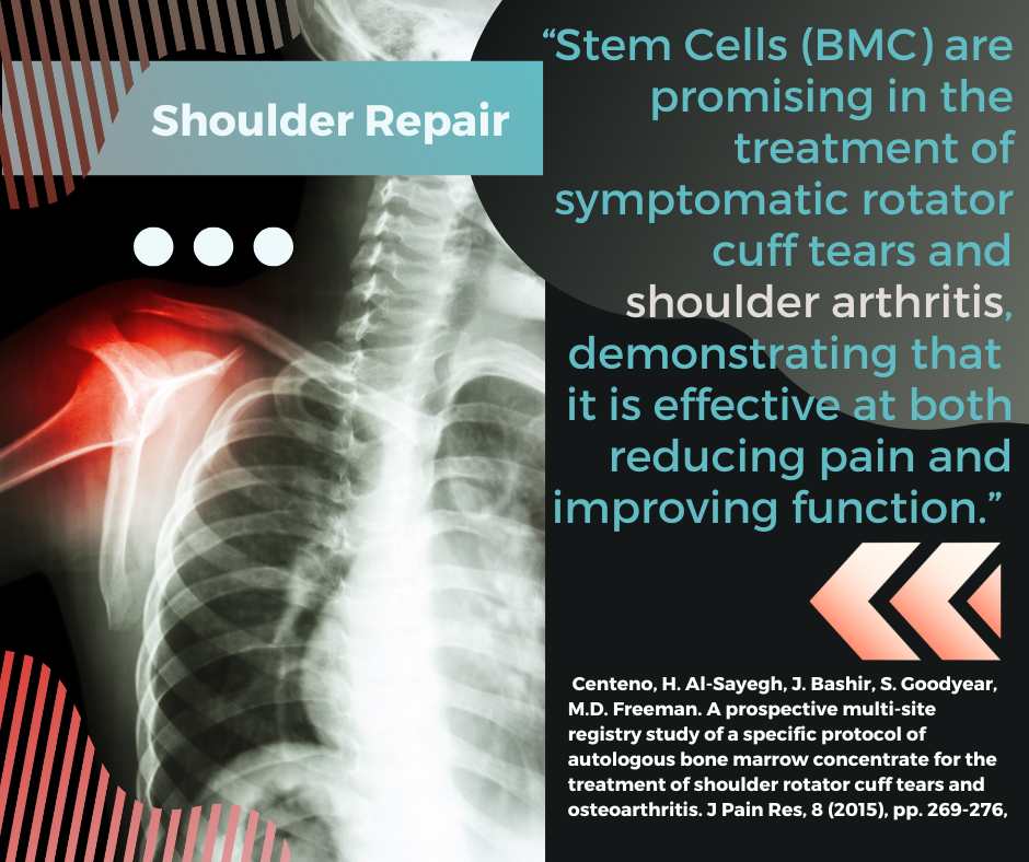 Shoulder Arthritis Repair